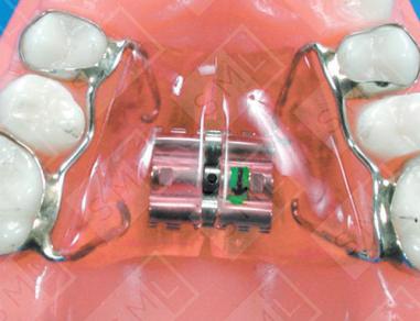 Memory Expansion Screw | Calgary